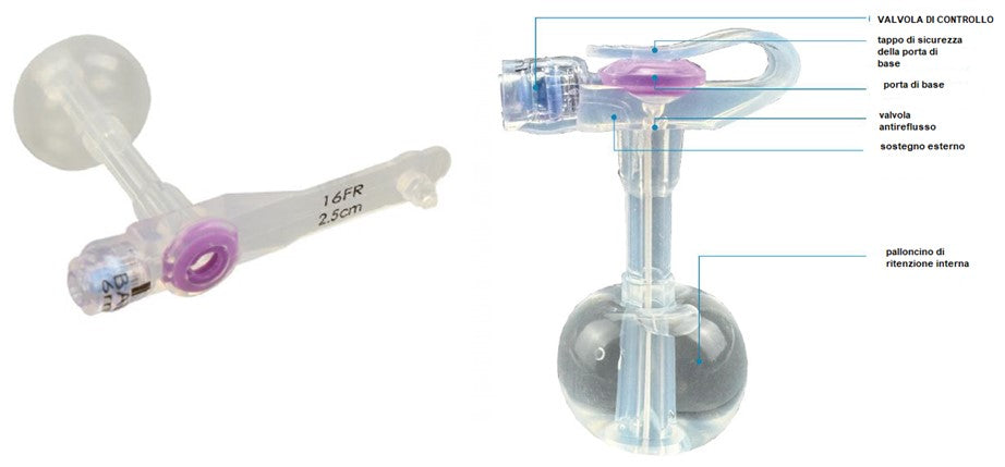 KIT PER GASTROSTOMIA MINI-BUTTON (SONDA A BASSO PROFILO TIPO MIC-KEY ...